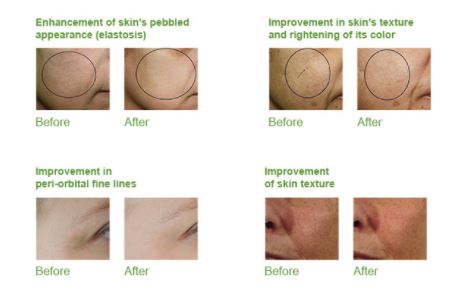 Geneo - Super Facial - The Mulberry Spa