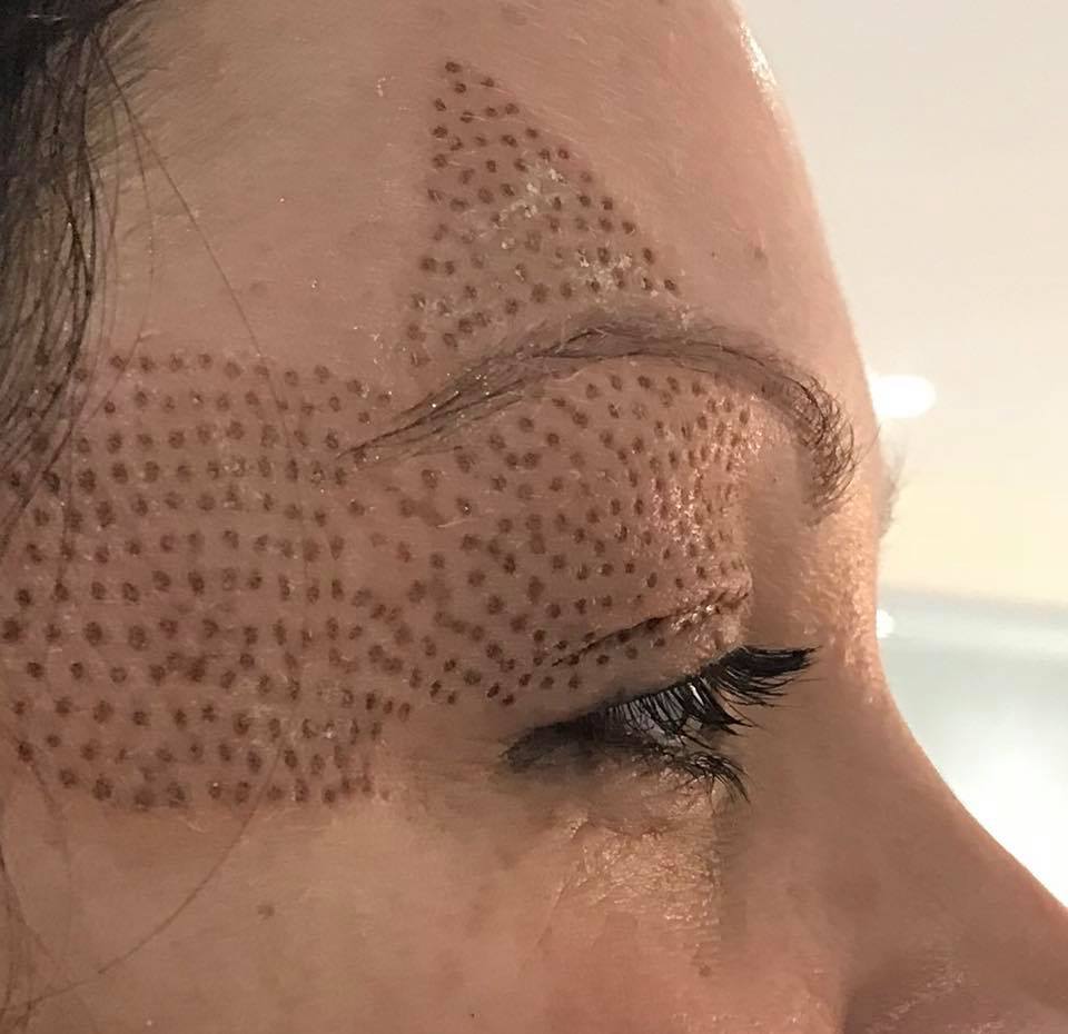 Plasma Pen Treatments - The Mulberry Spa